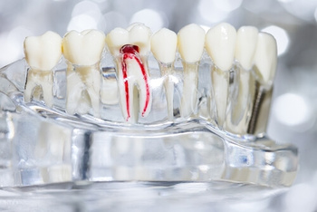 What Do the Teeth of a Drug Addict Look Like? – Calgary Addiction